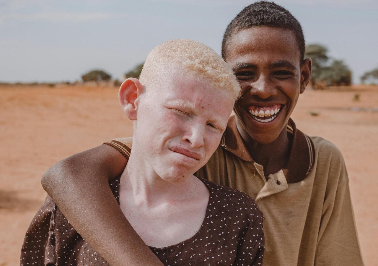 Pessoas Com Albinismo Pessoas Com Albinismo Terão Acolhimento De